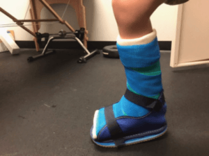 Serial Casting - ABC Pediatric Therapy