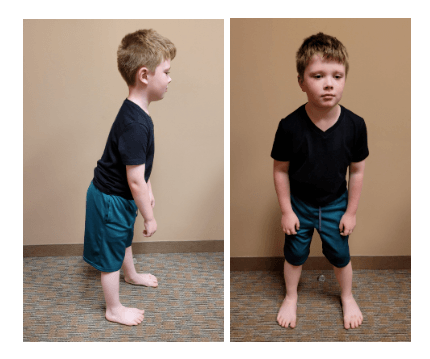 Serial Casting: What is it and When is it a Good Treatment Option ...